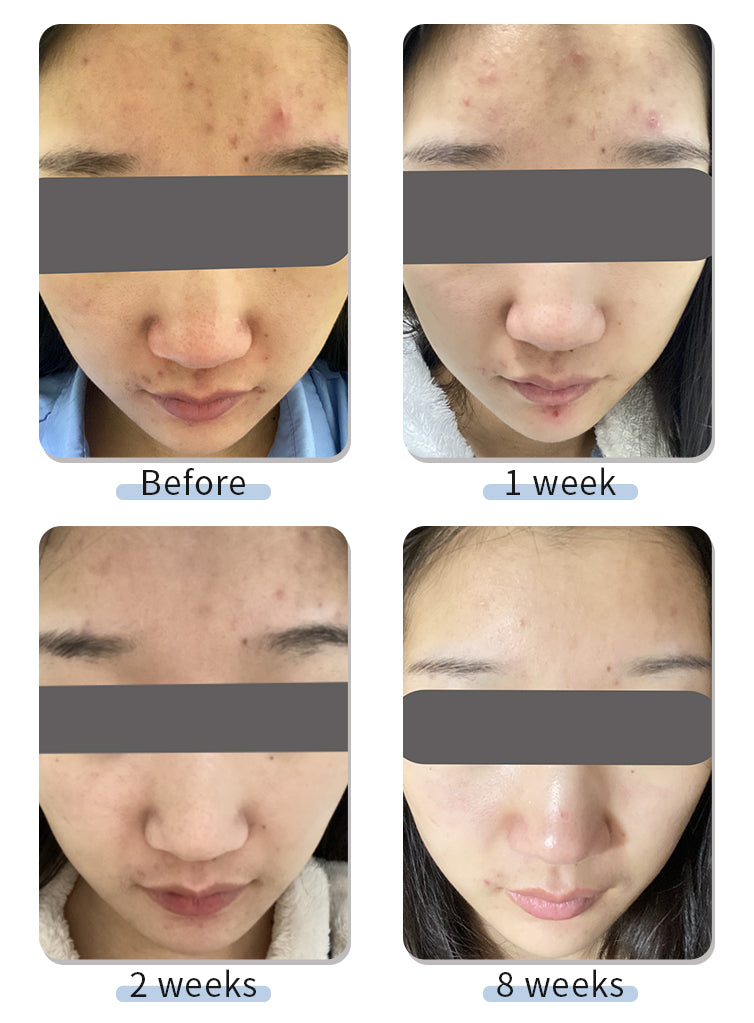 GYH Cloud S Wireless Infrared/Red & Blue LED Light Therapy Face Mask ...